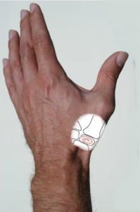 Thumb Joint Replacement | Restoration Plastic Surgery | Dr. Mitch ...